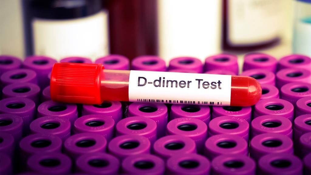 Dímero D | Lapi Laboratorio Médico