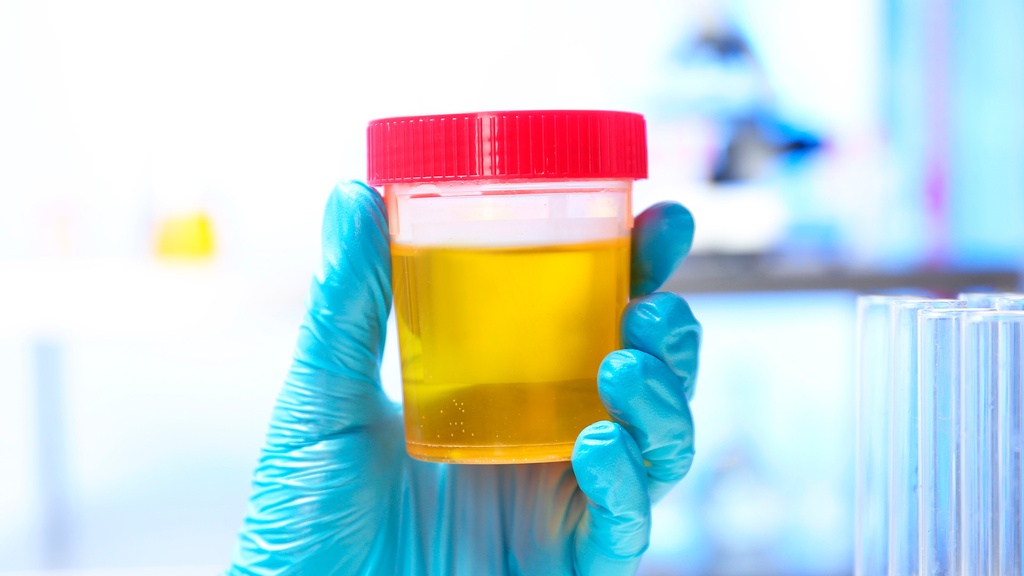 Examen General de Orina (EGO) | Lapi Laboratorio Médico