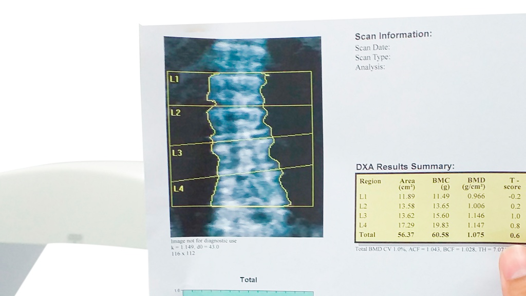 Densitometria de Columna Lumbar | Lapi Laboratorio Médico