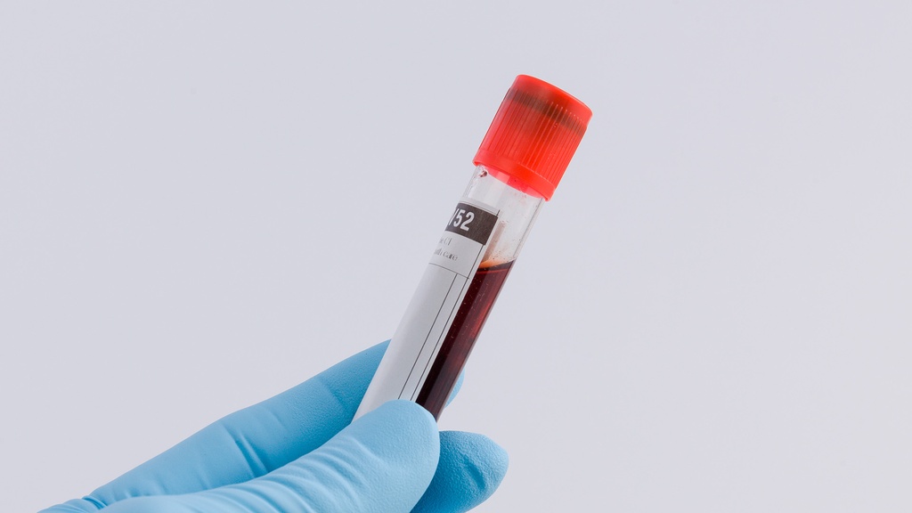 FibroTest - ActiTest | Lapi Laboratorio Médico