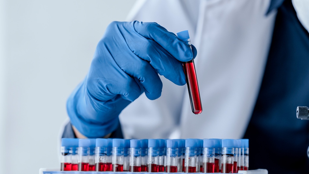 Proteina PTAU 217 | Lapi Laboratorio Médico